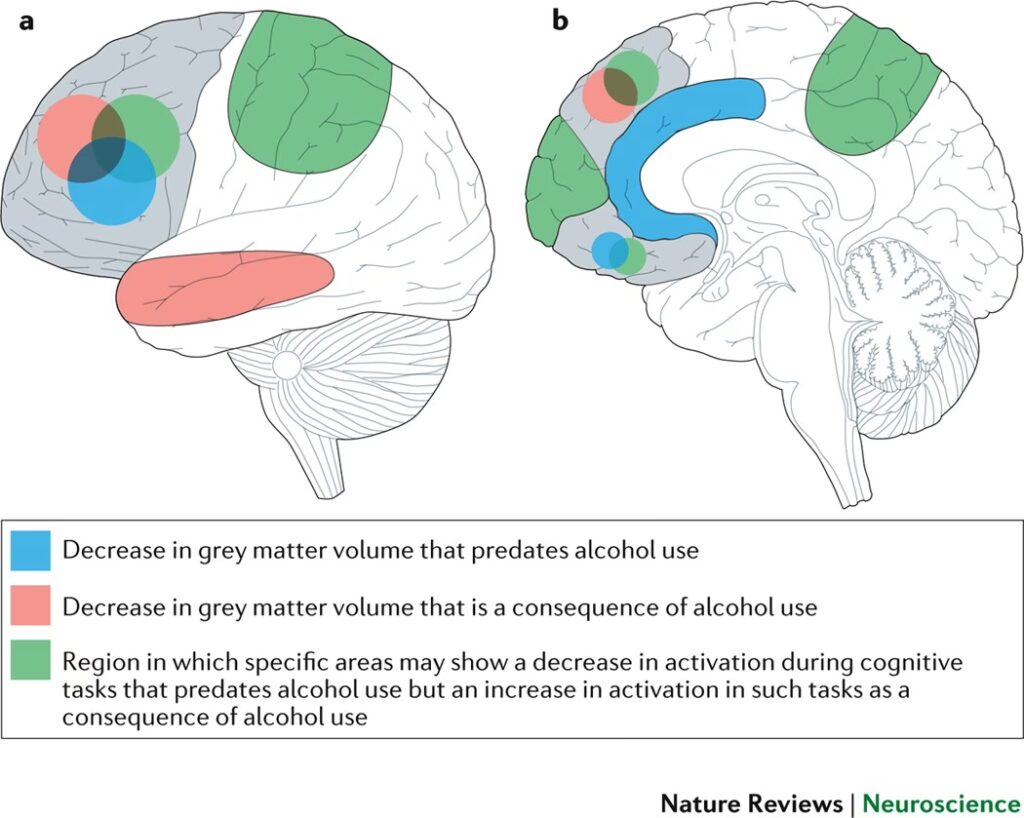 Daño Cerebral por Alcohol: Neuropsicología | iNeurociencias