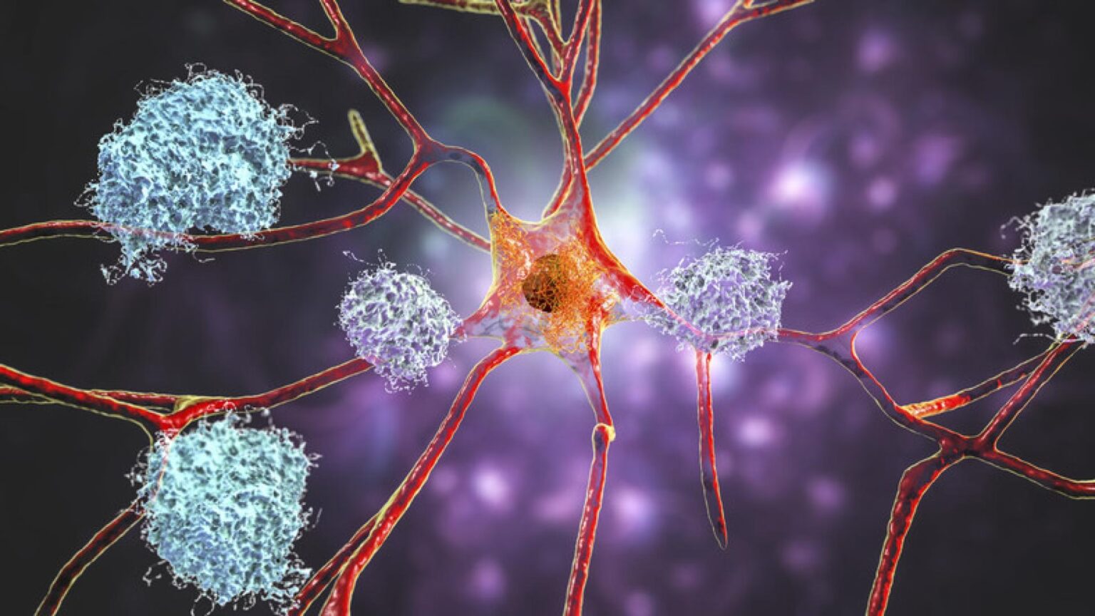 Amiloide en el Cerebro: Causas y Efectos | iNeurociencias