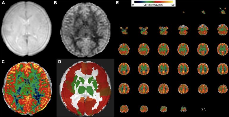 ASL: Perfusión Cerebral sin Contraste | iNeurociencias