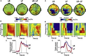 MEG vs EEG: Mapeo Cerebral y Epilepsia | iNeurociencias