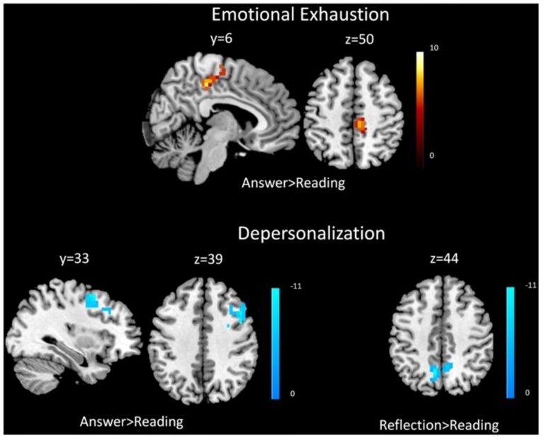 Burnout: Qué Sucede Realmente en Tu Cerebro | iNeurociencias